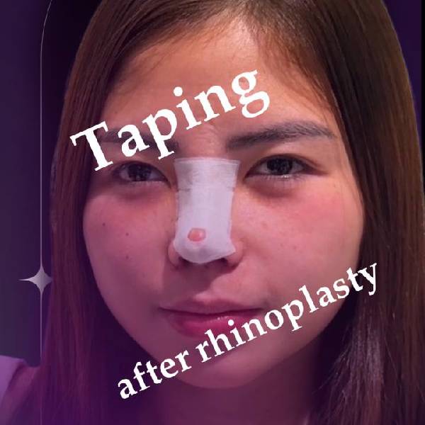 Taping After Rhinoplasty + How Long?