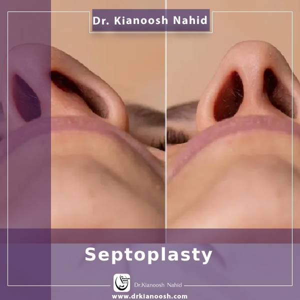 Septoplasty | Indications, Benefits, Complications, Efficiency, and ...