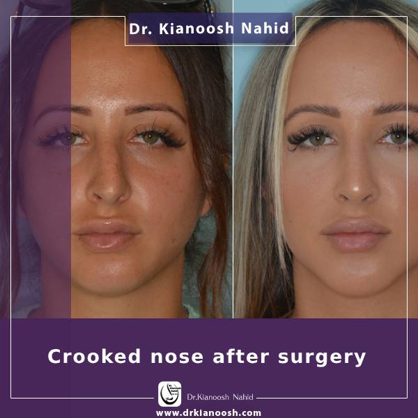 Crooked nose after surgery | Reasons why the nose looks crooked after ...